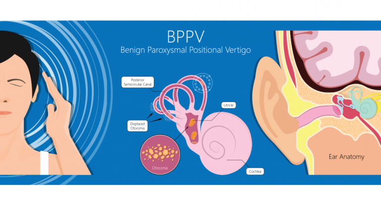 Balance & Vestibular Rehab - BPPV • Rising Tide Physical Therapy